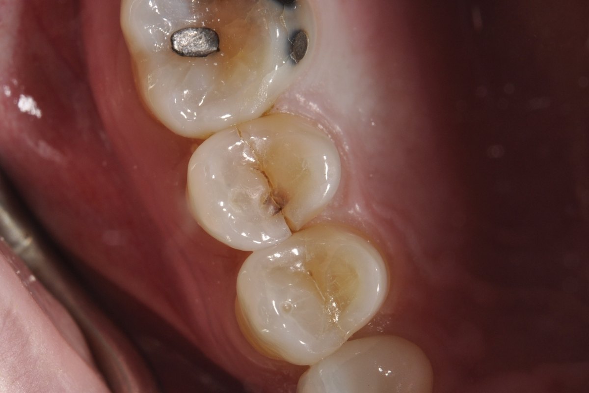 Rehabilitation Of A Patient With Bruxism And Clenching Gps Dental